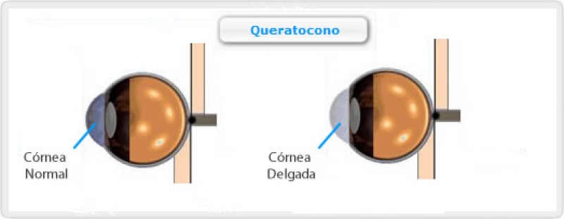 Origen del Queratocono · Clínica oftalmológica | Bogotá Láser